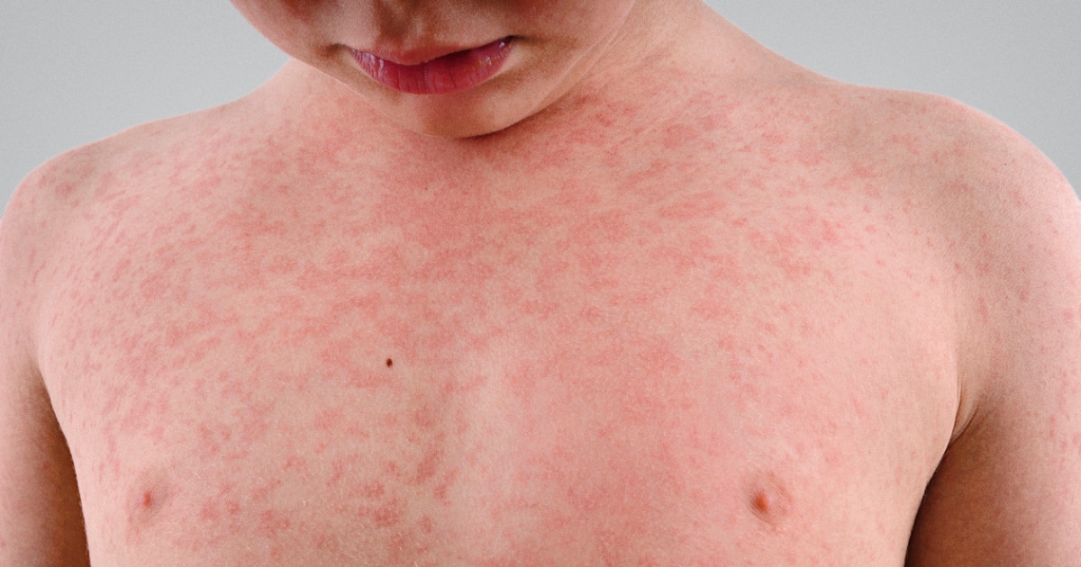 Rosolia: come proteggere sé stessi e il proprio bambino | UPPA.it