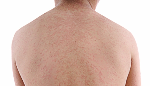 Rosolia nei bambini: dai sintomi alla cura - Uppa