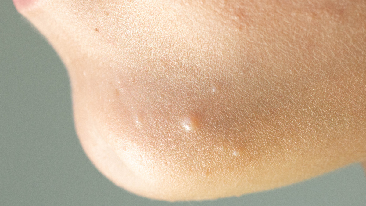 Mollusco contagioso: cause, sintomi e terapia - Uppa