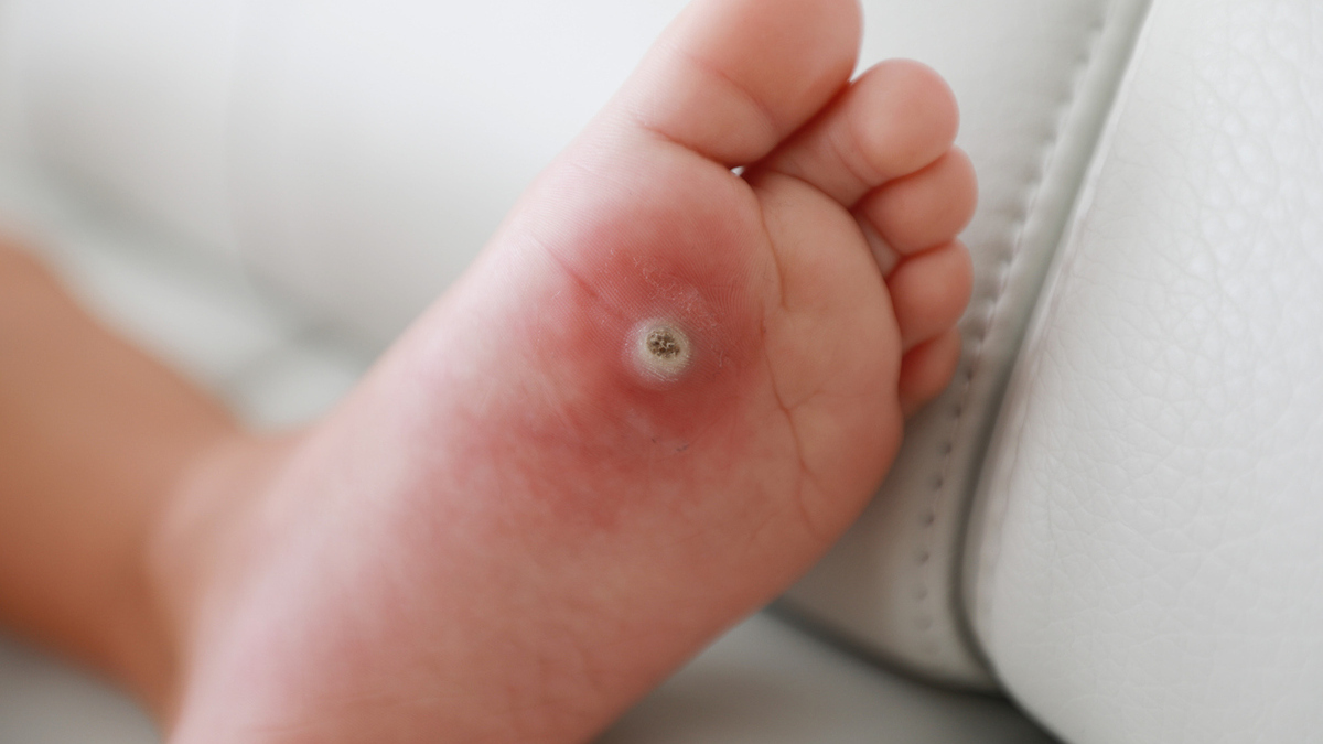Verruche nei bambini: come riconoscerle e trattarle - Uppa