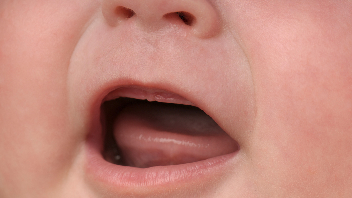 Frenulo linguale corto: cos’è e come si tratta - Uppa